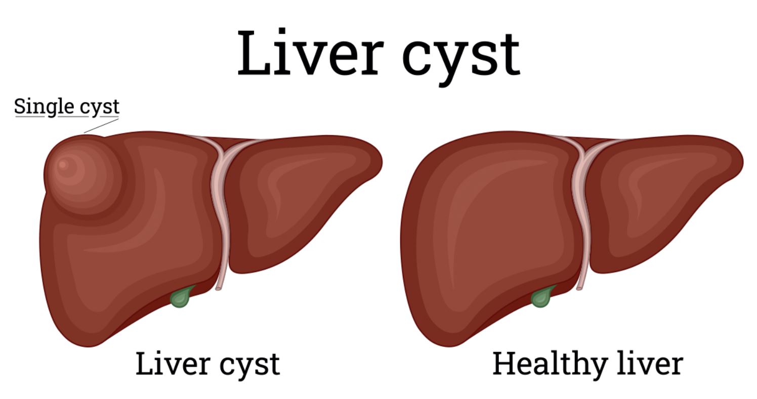 Cysty - typy, příznaky, léčba | Herbalus